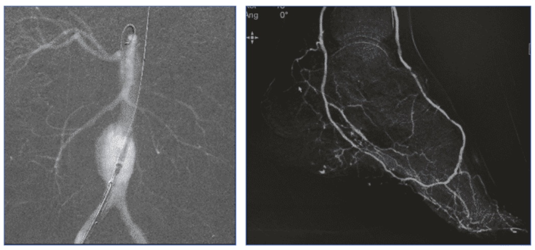 Carbon Dioxide (CO2) Angiography - The Vascular Surgeon